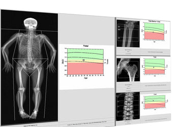 Understanding Your DEXA Scan Results: What They Mean and How to Track ...